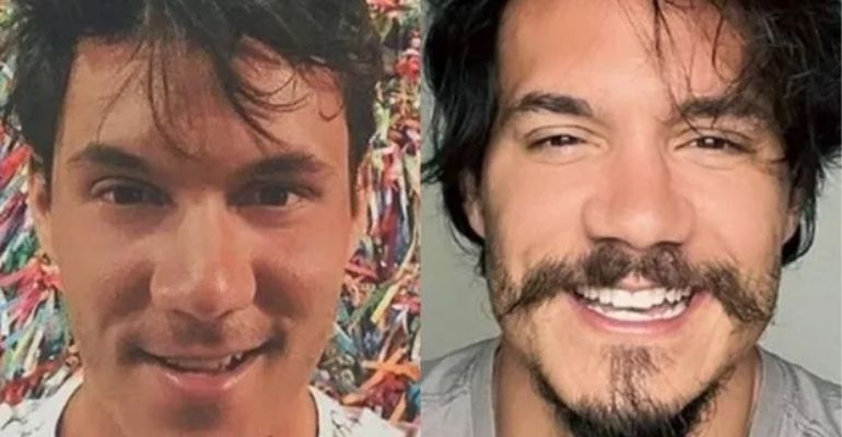 BBB 22: Eliezer revela quanto gastou na harmonização facial para entrar ... BBB 22: Eliezer revela quanto gastou na harmonização facial para entrar ...