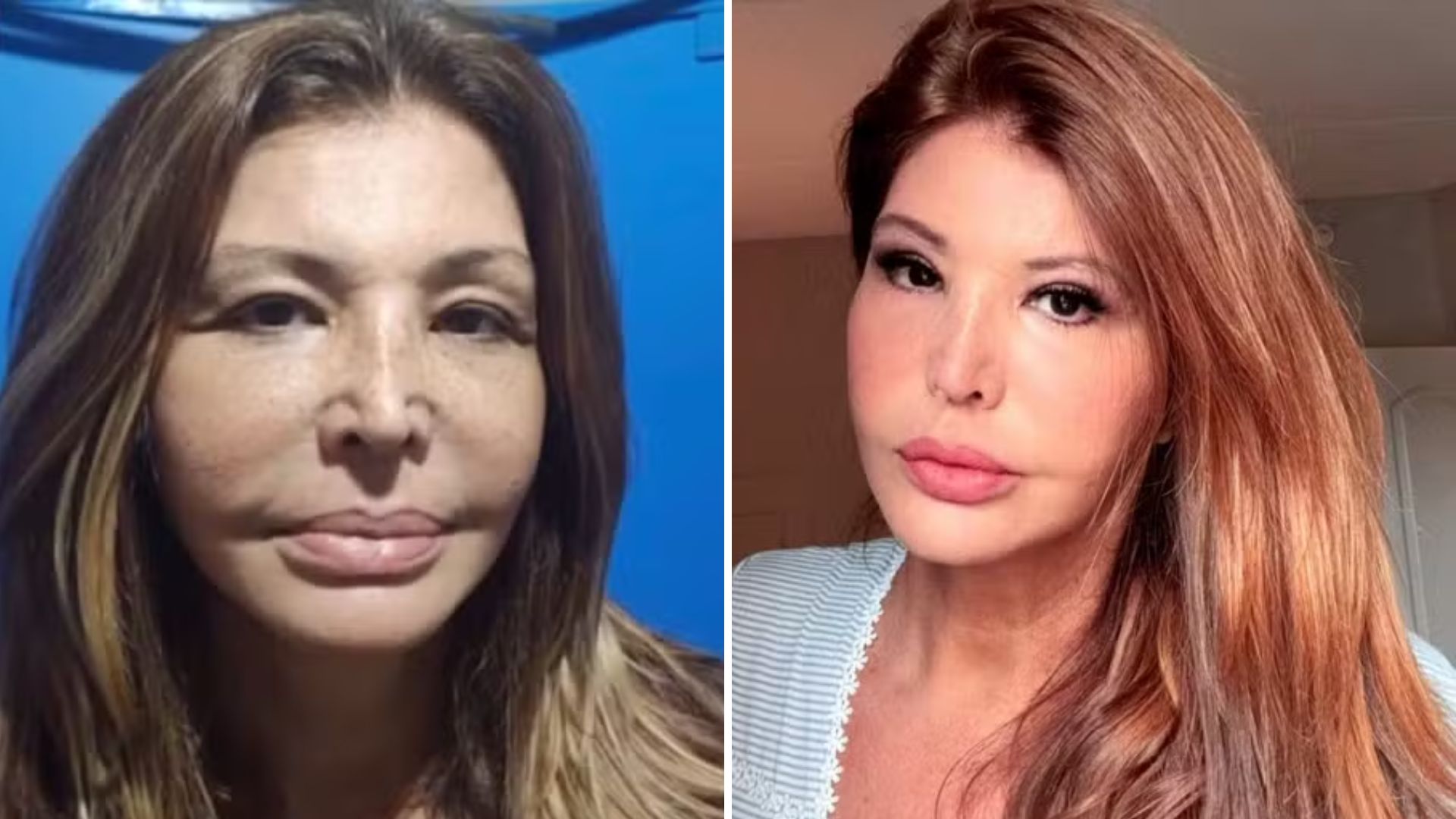 Roberta Close faz cirurgia plástica aos 60 anos e especialista alerta ...